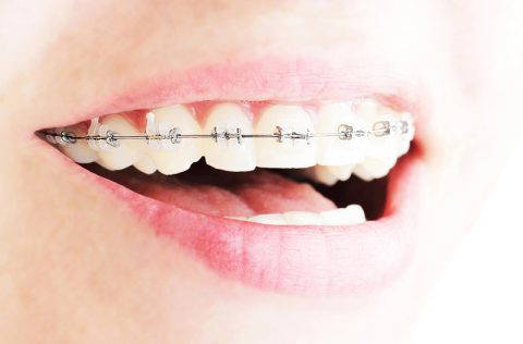 Clear and Ceramic Braces, Sutton Coldfield